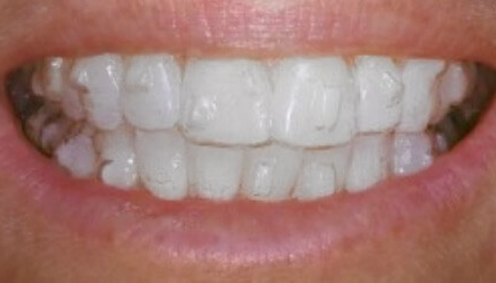 Invisalign Attachments - Comfortho, Smile Into Your Future :)