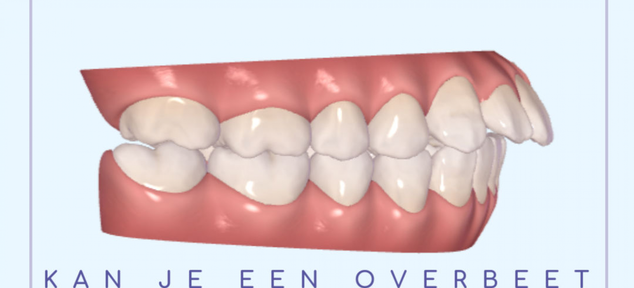 Overbeet corrigeren met Invisalign - Comfortho Invisalign ortho