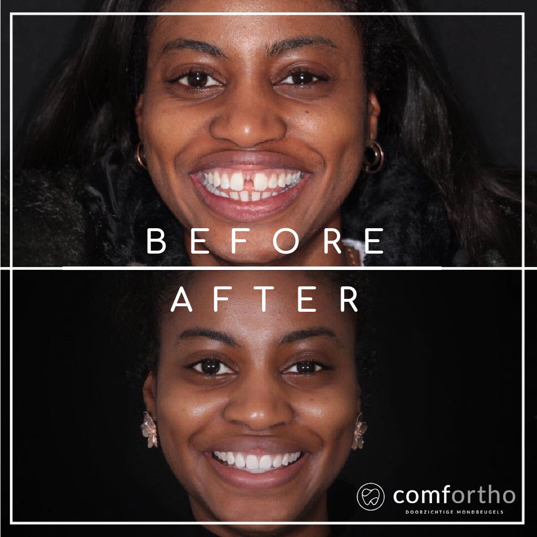 Spleetje tussen tanden verhelpen? - Comfortho, Smile Into Your Future :)